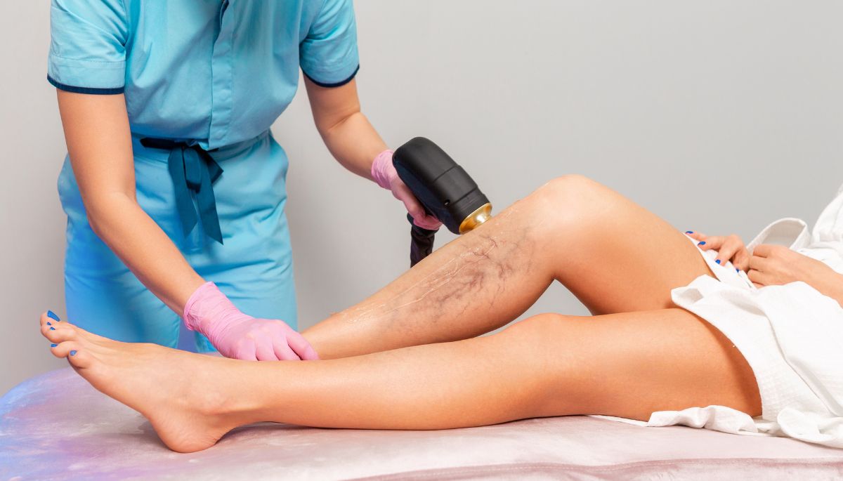 Wat zijn spataderen en hoe kun je ze voorkomen? Uitleg